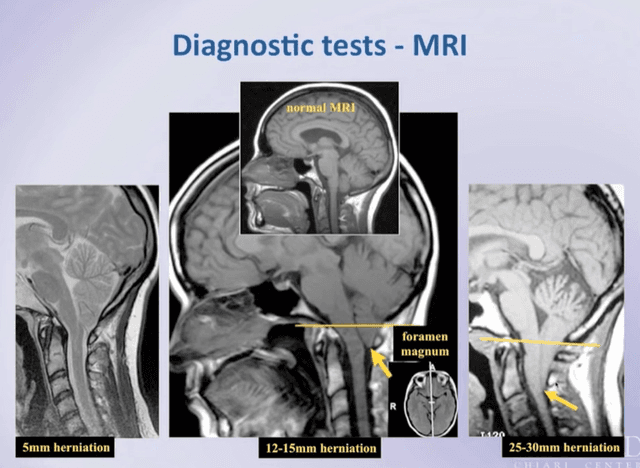 What is Chiari Malformation? | RTHM